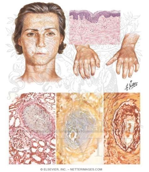 Progressive Systemic Sclerosis Scleroderma And Rheumatoid Arthritis