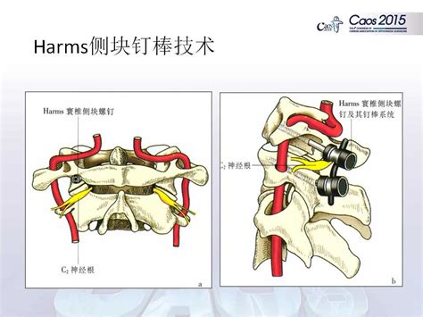 颈椎后路侧块螺钉图片 微创 机器人 大山谷图库