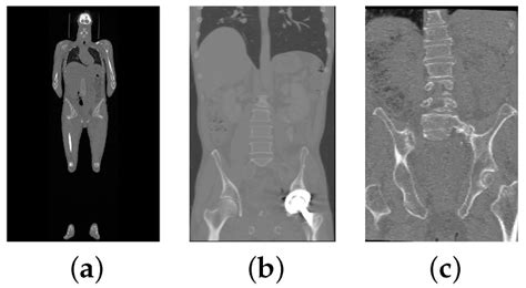 Lumbar And Thoracic Vertebrae Segmentation In Ct Scans Using A 3d Multi Object Localization And