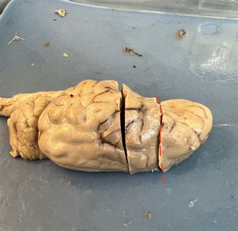 Coronal Dissection Planes Flashcards Quizlet