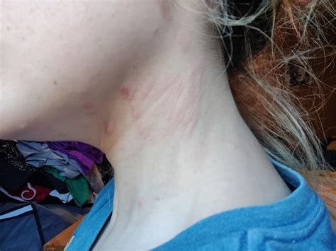 Poison Ivy Vs Scabies Backstory In Comments Rscabies