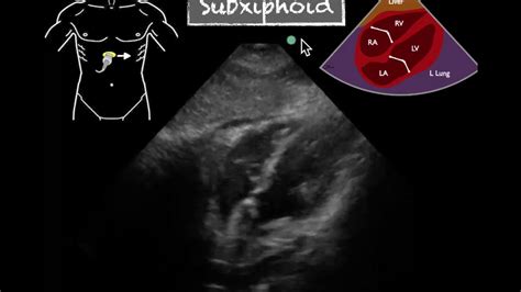 Pocus Cardiac Subxiphoid Normal Ef Youtube