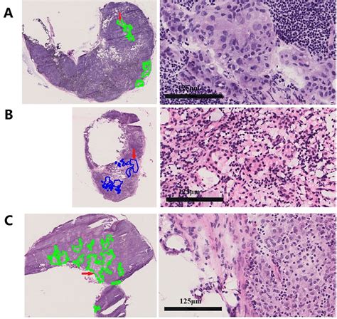 Pathology Experts Analysis Of The Misclassification Errors For The