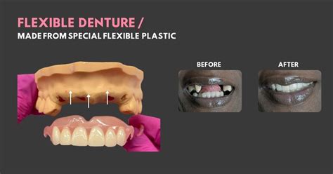Flexi Partial Dentures