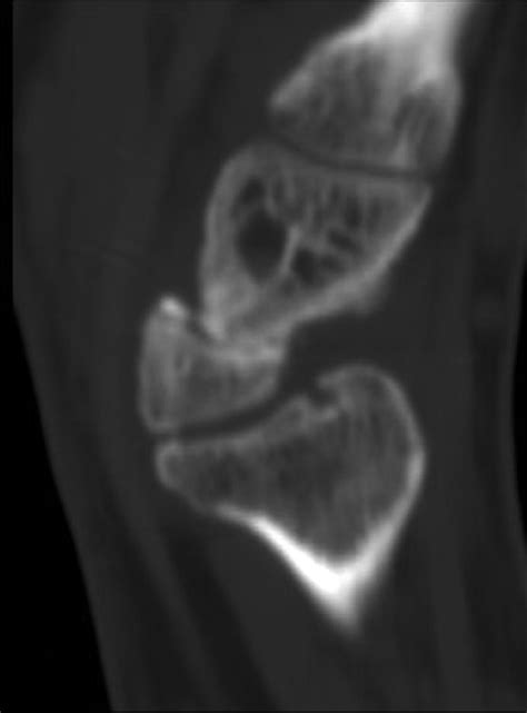 Proximal Row Carpectomy With Capsular Interposition Arthroplasty For Advanced Arthritis Of The