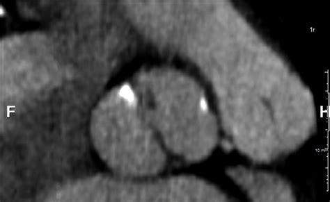 Bicuspid Aortic Valve The Common Vein