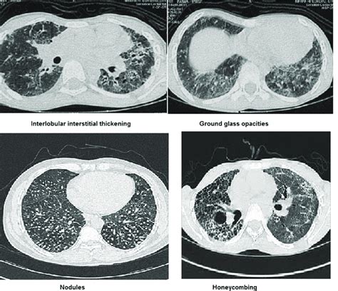 Radiological Features In Ild Download Scientific Diagram