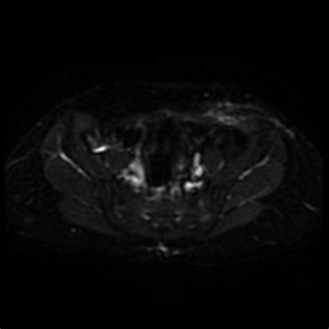 Cesarian Section Scar Endometriosis Radiopaedia 66520 75799 Axial Dwi