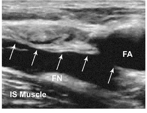 An Ultrasound Image Inferior To The Inguinal Ligament Shows A Download Scientific Diagram