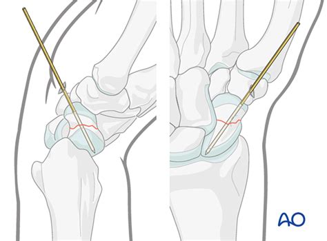Percutaneous Screw Fixation Through A Palmar Approach For Scaphoid Waist Fracture