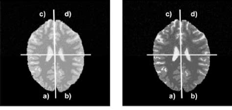 figure 1 from markov random field segmentation of brain mr images
