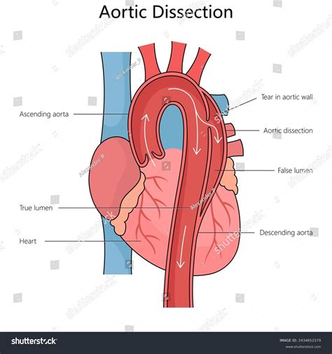 Aortic Bodies Over 332 Royalty Free Licensable Stock Vectors And Vector Art Shutterstock