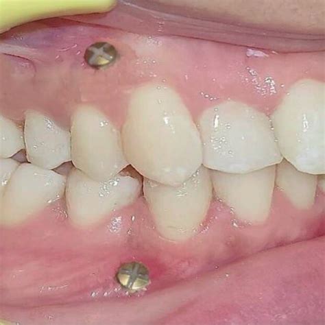 Temporary Anchorage Device Download Scientific Diagram