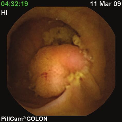 Sigmoid Colon Polyp Download Scientific Diagram