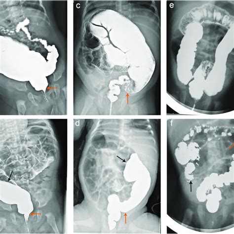 Barium Enema Findings In Hscr Patients A B The Barium Enema