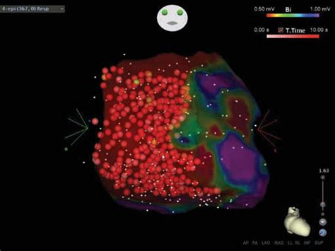 Figure 1 From Catheter Ablation Of Scar Mediated Ventricular