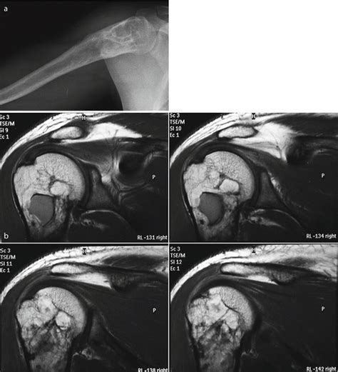 Bone Infarct Musculoskeletal Key