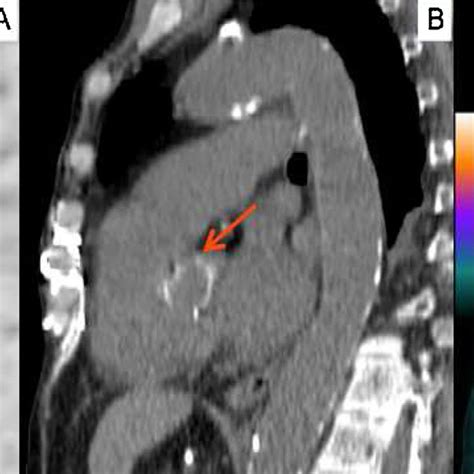 Patient Hospitalisé Pour Endocardite à Enterococcus Faecalis Sur Download Scientific Diagram