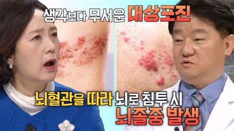 좋은아침 뇌졸중 유발하는 무서운 질병 ‘대상포진 황금마이크 Sbs