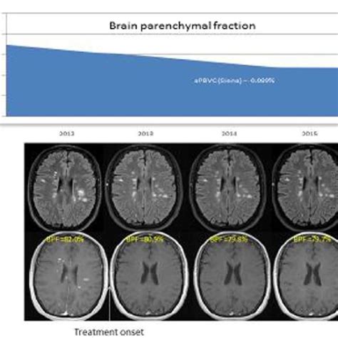 Illustration Of A Longitudinal Effect Of Treatment On Brain Parenchymal Download Scientific