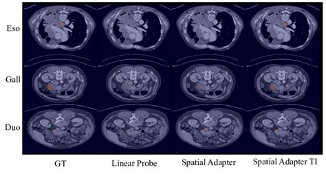 qualitative evaluation the axial view of preprocessed ct scans the