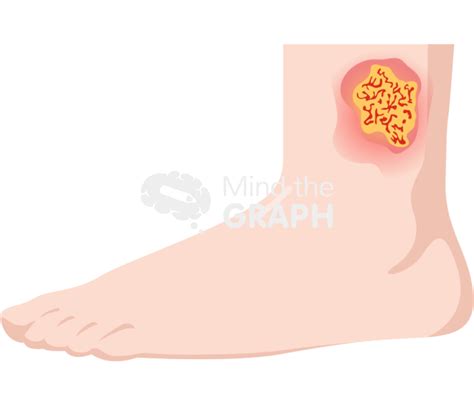 Pyoderma Gangrenosa