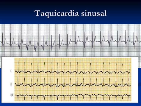 Ppt Taquiarritmias Supraventriculares Powerpoint Presentation Free