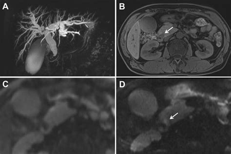 A 49 Year Old Man With Distal Common Bile Duct Cbd Carcinoma With A
