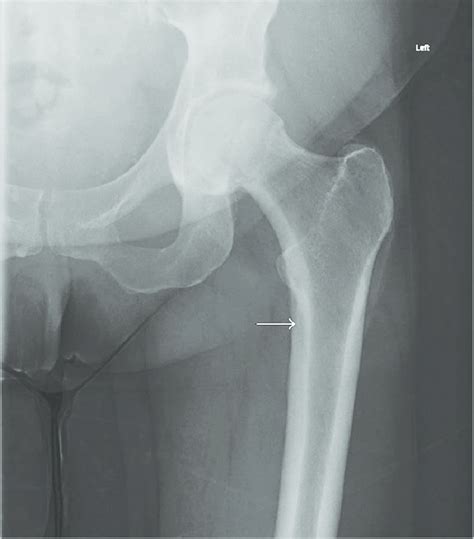Single Frontal Radiograph Of Left Hip Demonstrates Subtle Medial