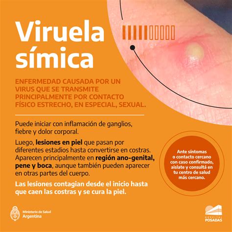 Viruela Símica Síntomas Y Prevención Argentinagobar