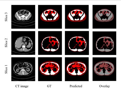 Figure 2 From Detection Of Sarcopenia Using Deep Learning Based Artificial Intelligence Body