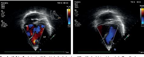 Figure 4 From Giant Apical Left Ventricular Diverticulum In A Health