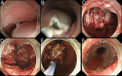 The Key Steps Of Eftr A Endoscopic View Of E Gist B Submucosal Download Scientific Diagram