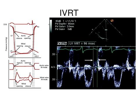 Ppt Echocardiographic Evaluation Of Lv Diastolic Function Powerpoint Presentation Id 5164466