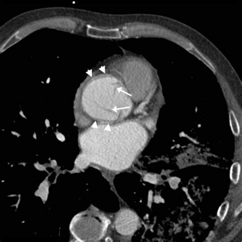 Transesophageal Echocardiogram Transesophageal Echocardiographic Scan Download Scientific