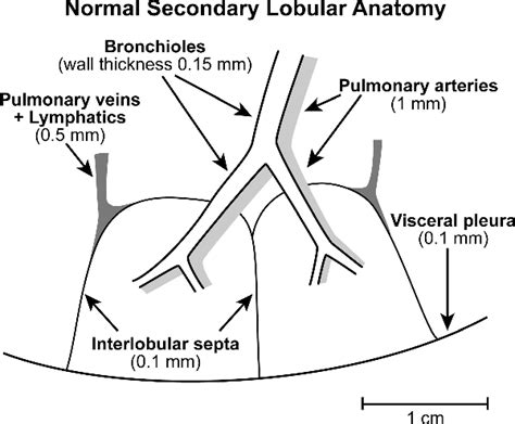 Figure 1 From A High Resolution Ct Scan Diagnostic Algorithm Semantic
