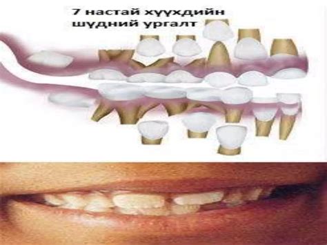 сүүн шүд болон байнгын шүдний онцлог Pptx