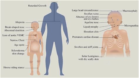 Hutchinsongilford Progeria Syndrome Unraveling The Genetic Basis