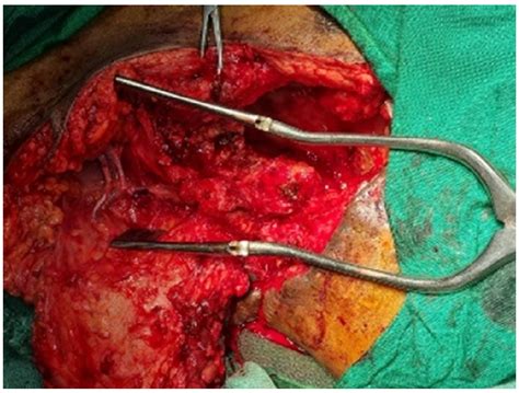 The Thoracodorsal Neurovascular Bundles Identified As The Recipient Download Scientific Diagram