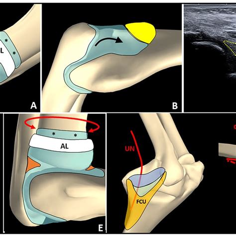 Imagens Of A Normal Mcp Joint And An Abnormal Mcp Joint Of A Ra