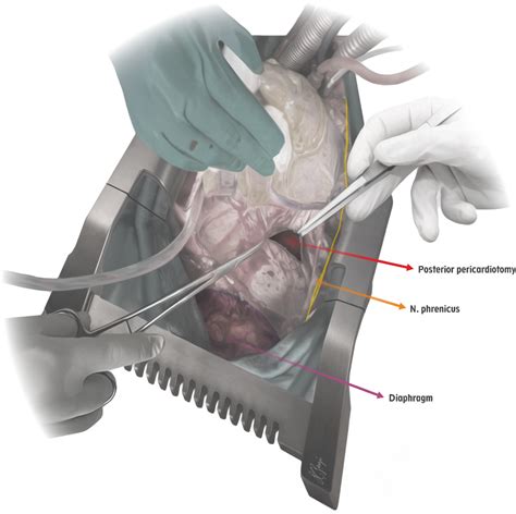 Posterior Pericardial Window A Simple And Reproducible Technique In Order To Prevent