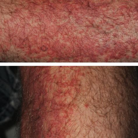 What Is The Cause Of This Mans Itchy Leg Rash Consultant360