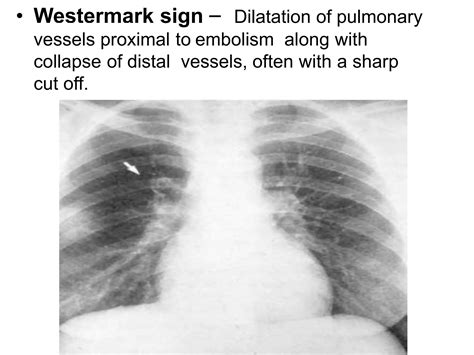 Pulmonary Embolism Radiology Imaging Pptx
