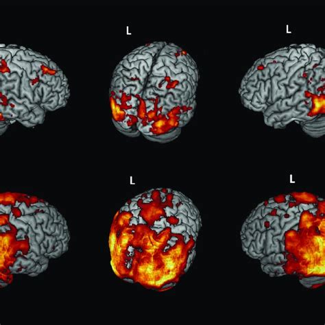 Voxel Based Morphometry And Voxel Based Metabolism Results Showing Download Scientific Diagram