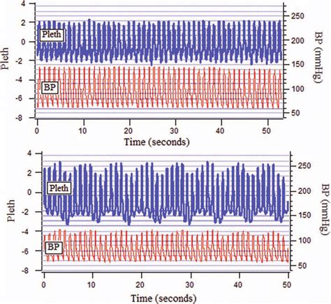The Effect Of Blood Loss On The Pulse Oximeter Waveform Pleth And Download Scientific Diagram