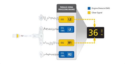 Masimo Next Generation Sedline® Brain Function Monitoring Masimo Next Generation Sedline® Brain Function Monitoring