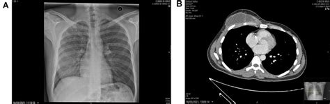A Chest X Ray Linear Nodular Density Right Upper Lobe B Ct Thorax Download Scientific