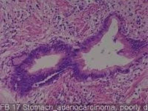 Novus Biologicals™ Stomach Matched Cancer And Normal Tissue Microarray