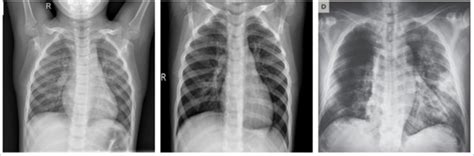 Cxr Images With Differece Class A Normal B Viral Pneumonia And Download Scientific