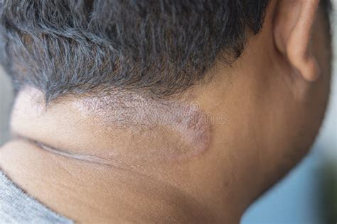 Dark Skinned Asian Men Suffer From Scalp Dermatitis Due To Moisture Causing Fungi Fungal